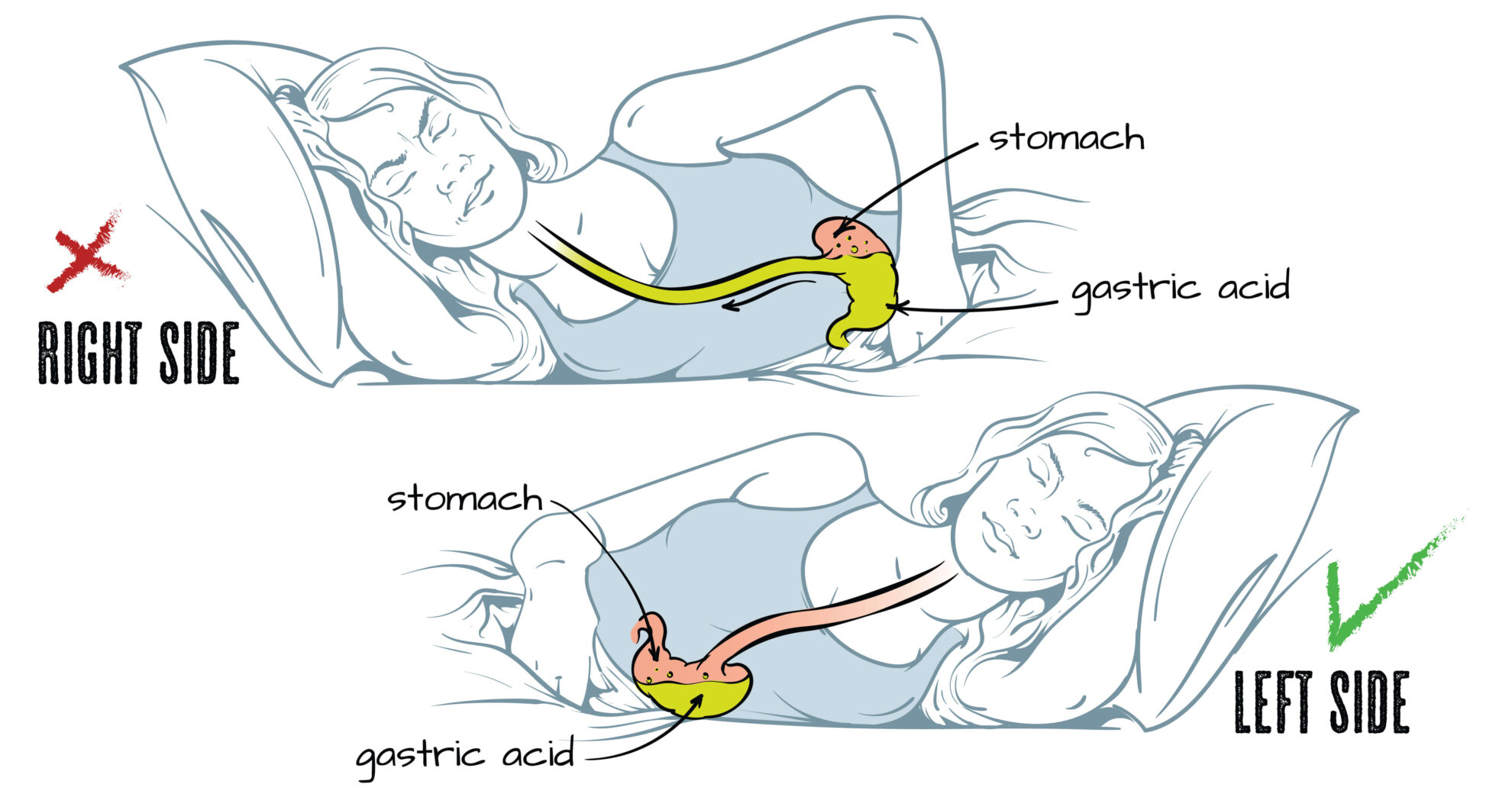 Why Sleeping on Your Left Side Supports Digestion and Reduces Acid ...