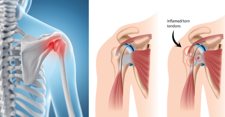 10 Ways To Get Rid of Frozen Shoulder: Unwind Deep Tension and Restore ...