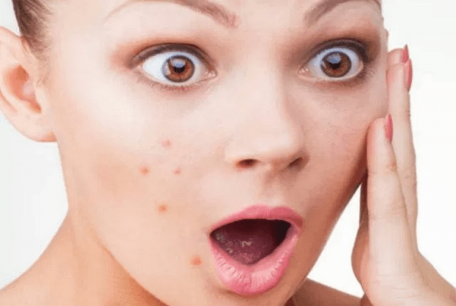 Can Coconut Oil Give You Acne?